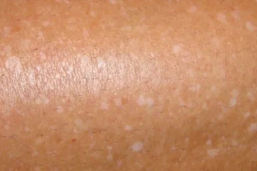 White Spots on Body, Causes, Small, Sun, Fungus, Tanning, Legs, Cancer ...